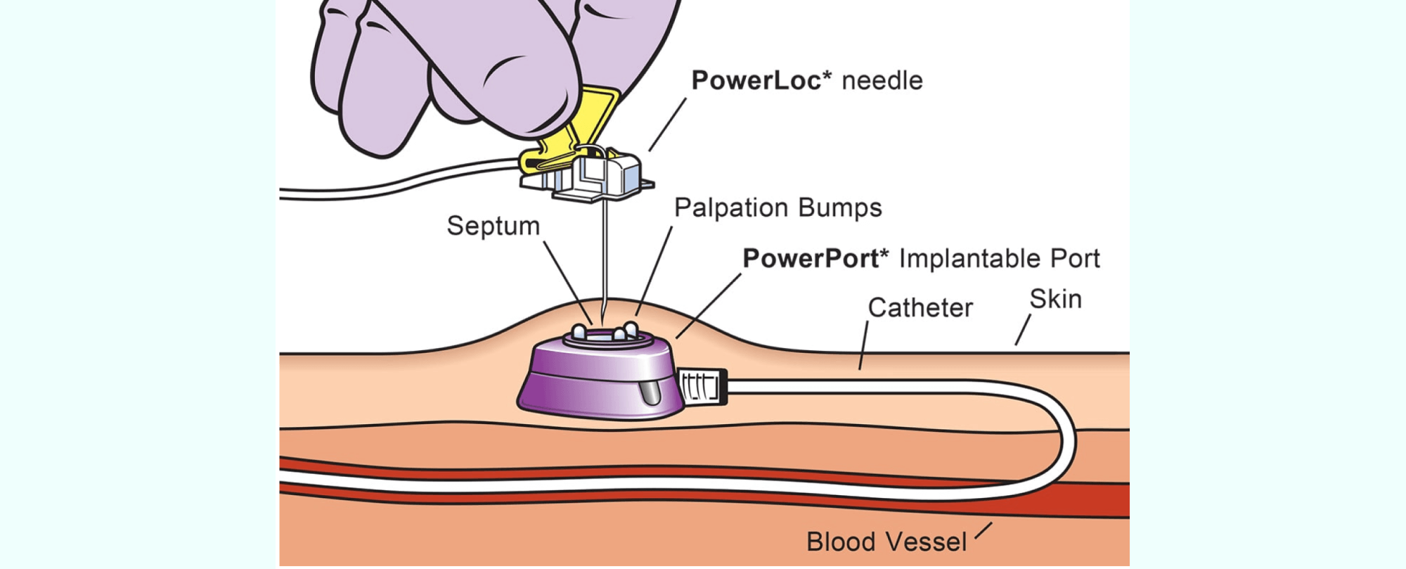 Catéter con puerto: lo mejor para un tratamiento IV prolongado. – Avansalud