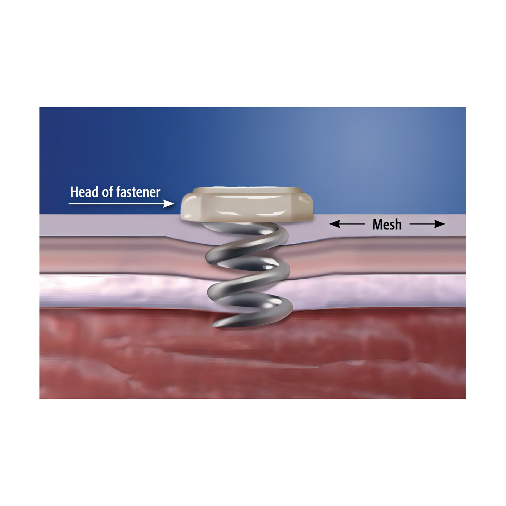 CapSure Fijador helicoideal Grapadora – Avansalud