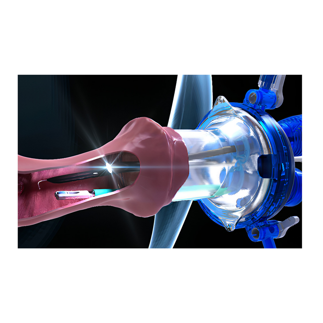 GelPOINT® Path Transanal – Avansalud