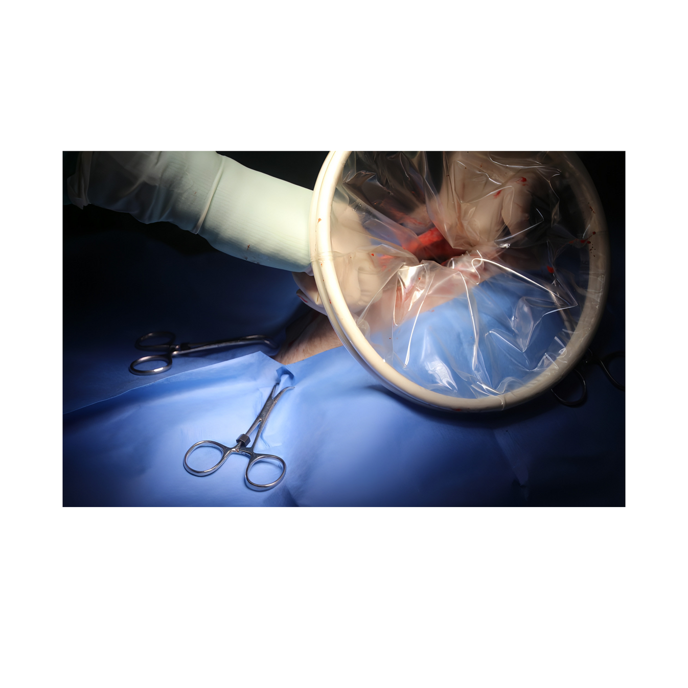 Alexis® Retractor / Protector de Heridas – Avansalud